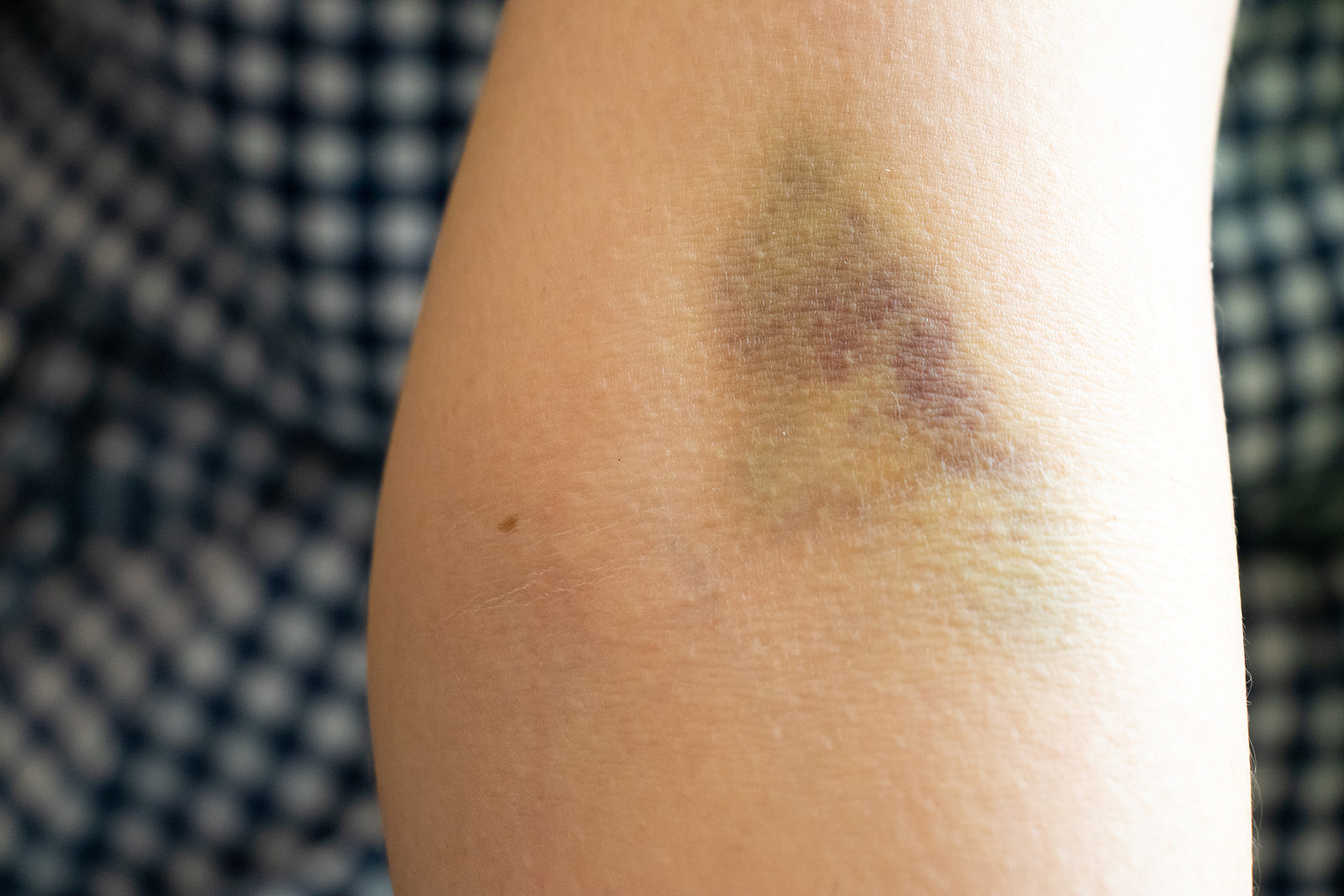 Does Vitamin E Contribute to Easy Bruising? | The People's Pharmacy